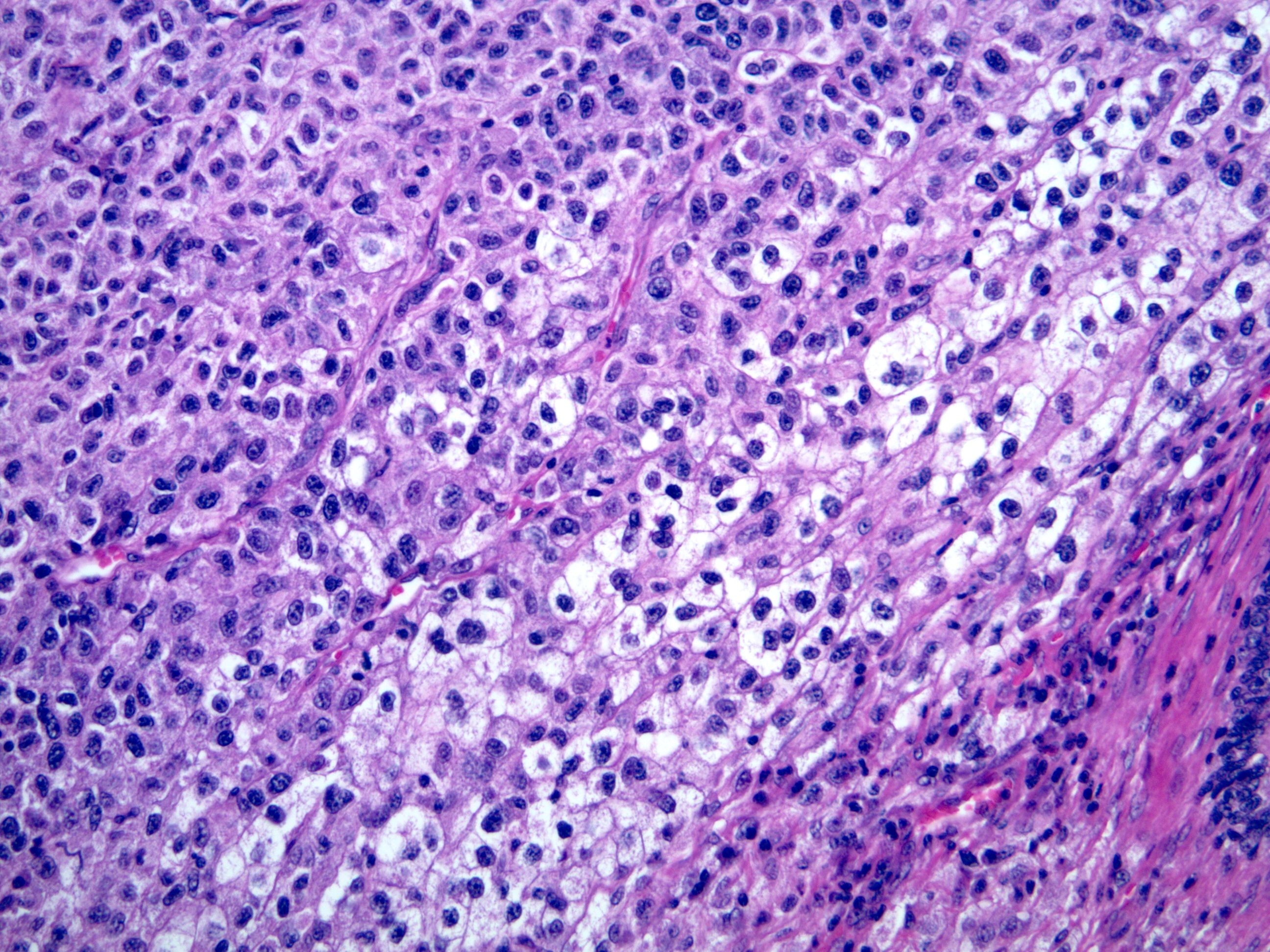 Solitary Lung Nodule In A Smoker KiKo XP